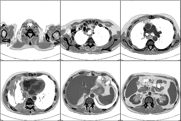 TCGA-LUAD肺癌CT图像数据-大白智能