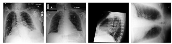 胸部MIMIC-CXR数据库-大白智能