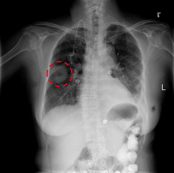 胸部NIH Chest X-ray数据集-大白智能